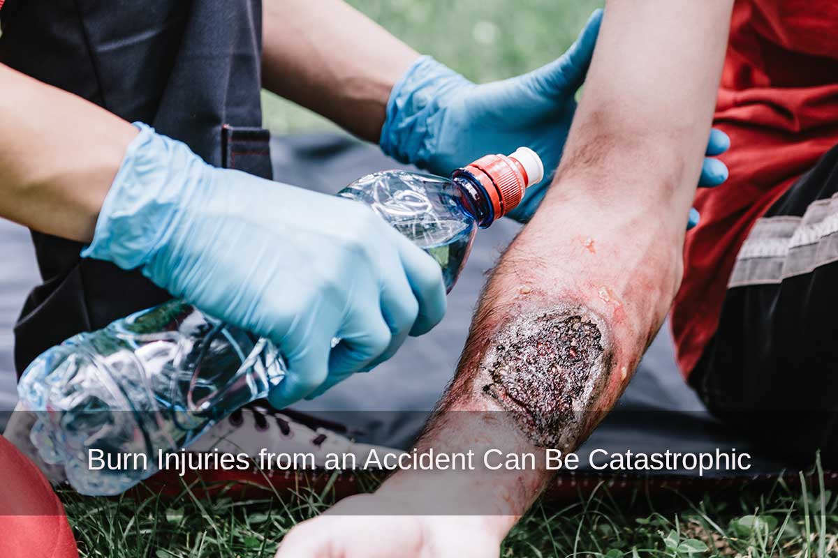Burn Injuries Can Be Catastrophic | The Jewkes Firm